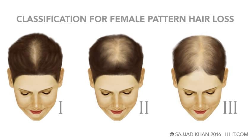 Women Hair Loss Ilht Dubai